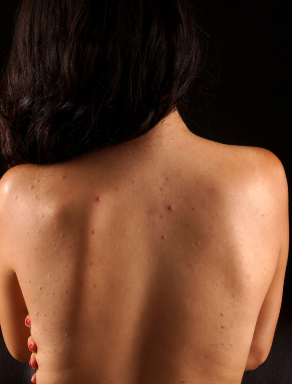 ASAP Clear Skin Body Acne Treatment (preparation required) – Spa Hotel ...